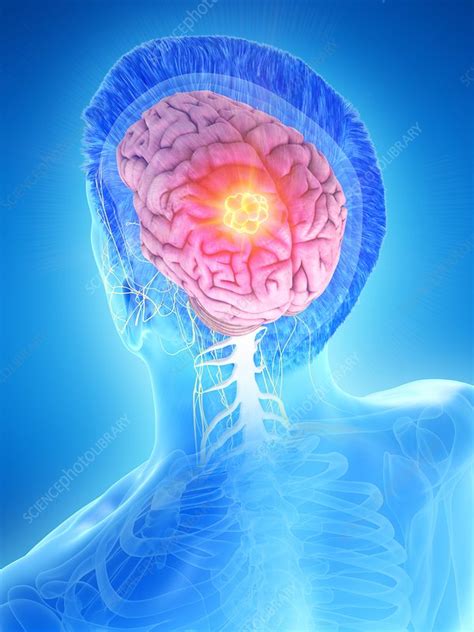 Brain Tumour Conceptual Illustration Stock Image F Science Photo Library