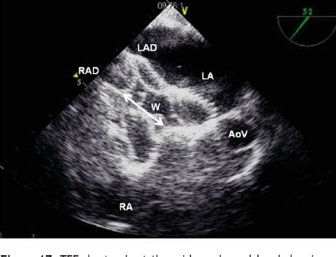 Figure 1 From Multiplanar Transesophageal Echocardiography For The