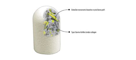 Product Profile Osteogen Bone Grafting Plug Dentaltown