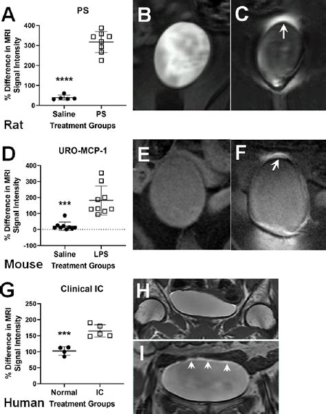 Figure 1 From Mri As A Tool To Assess Interstitial Cystitis Associated