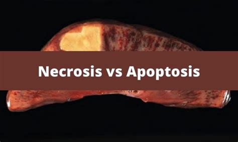 Apoptosis Vs Necrosis Medical Junction
