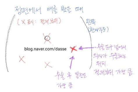 자궁 및 양측 난소 나팔관 절제 수술2준비과정 수술 입원 퇴원 후 회복 네이버 블로그