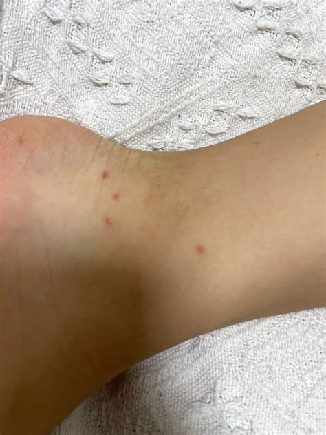 진드기 물린 자국 맞나요 지식in