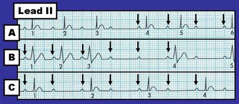 Ecg Interpretation Ecg Interpretation Review 19 2 To 1 Av Block