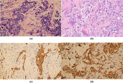 Pathological Pictures Of MBC With Osseous Differentiation Excision Download Scientific Diagram