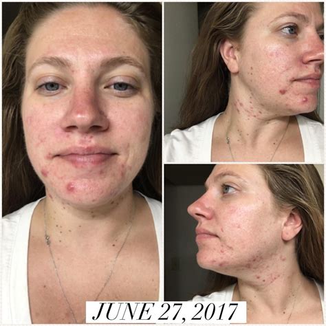 30 Best Products For Hormonal Acne In 2025