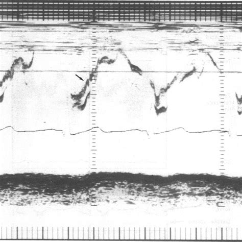 M Mode Echocardiography Of The Tricuspid Valve Showing The High