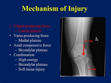 Proximal Tibia Fractures And Its Management Pptx