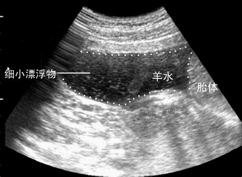 羊水是怎样影响胎儿发育的