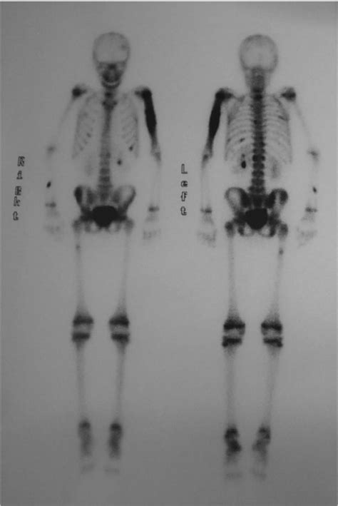 The Patient 11 Year Old Male Had Multiple Bone Metastases And Bone