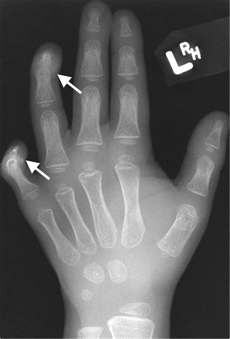Linear Scleroderma Manifested By Hyperpigmentation And Skin Tightening Download Scientific