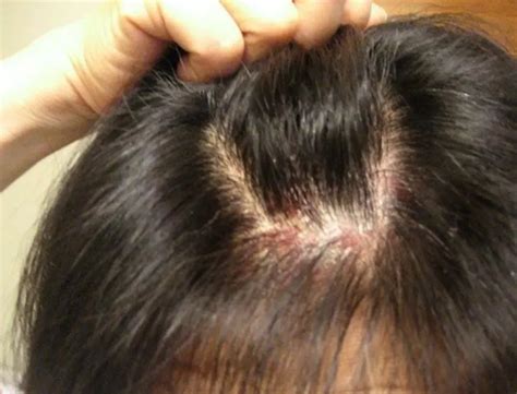 Scalp Dandruff Scalp Psoriasis Vs Dandruff Symptoms Pictures And