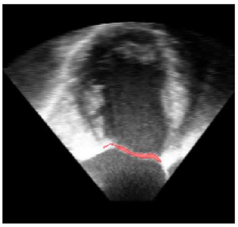 An Exampled Of A 3d Thin Tissue Detection Of Mv Leaflets Left Long