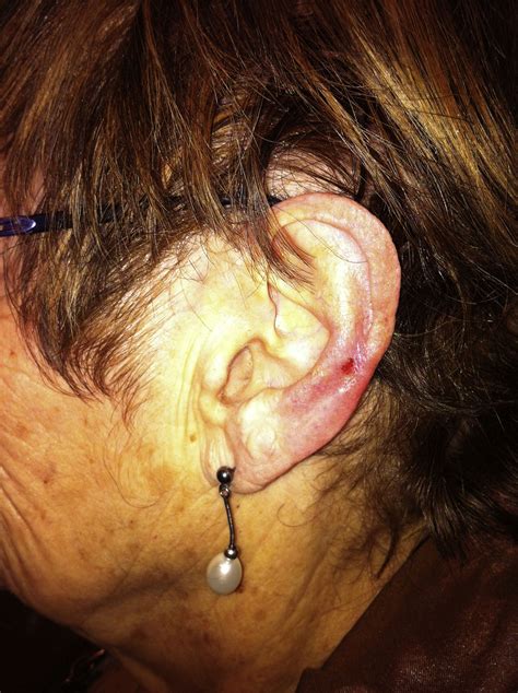 Chondrodermatitis Nodularis Helicis Successful Treatment With 2