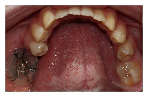 Clinical A And Radiographic B Aspects Of The Compression Device Download Scientific Diagram