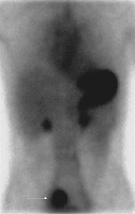 Technetium 99 M Pertechnetate Radionuclide Scan High Uptake Area