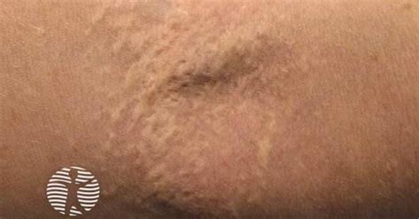 Dermnet® Pseudoxanthoma Elasticum Image