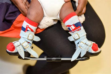 Types Of Braces For Clubfoot At Becky Uhl Blog