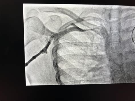 Compressed Subclavian Vein On A Venogram Guess The Diagnosis R Xrayporn