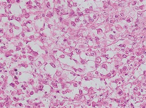 Proximal Type Epithelioid Sarcoma Of The Vulva A Case Report Pmc