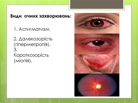 Захворювання очей - презентация онлайн