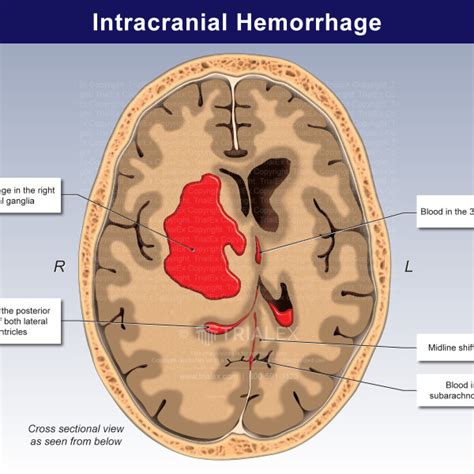 Idiopathic Intracranial Hypertension Pseudotumor Cerebri Tria