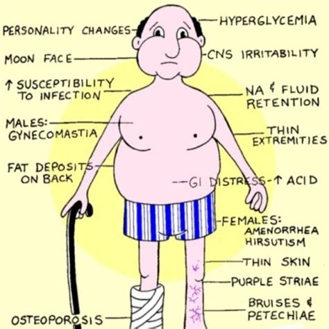 A Case Of Cushing Syndrome Due To Steroid Administration Showing