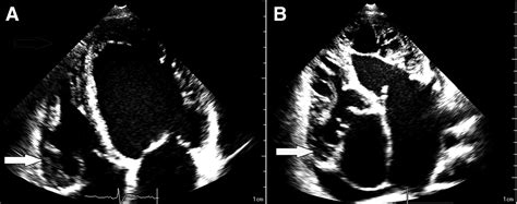 Non Compaction Radiology At Jimmy Milam Blog