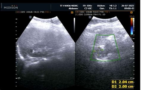 Vietnamese Medic Ultrasound Case 691 Left Adrenal Tumor Dr Phan