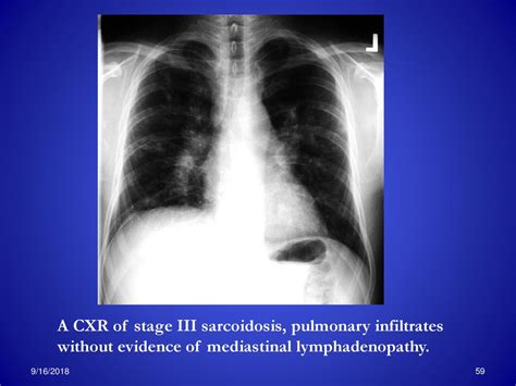 Interstitial Lung Disease And Sarcoidosis Ppt Download