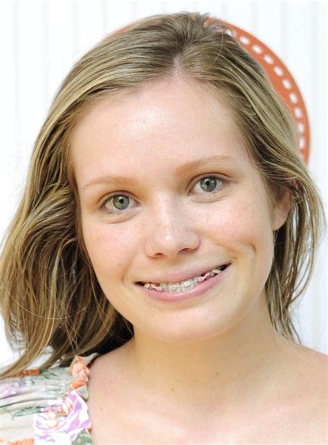 Braces Braceface Metalbraces Girlswithbraces Elastics Powerchain Beautiful Smile Brace