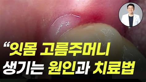 잇몸에 생기는 고름주머니 2가지 원인과 치료법 Youtube