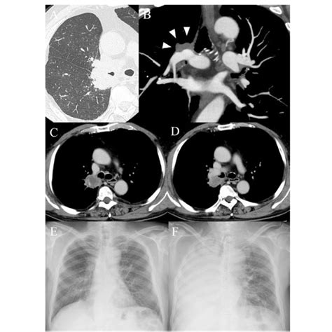 Tracheal Carinal Site After Lymph Node Dissection A Incision In The Download Scientific