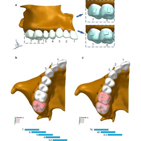 Three Dimensional Fea Model For Molar Distalization A Maxillary Arch