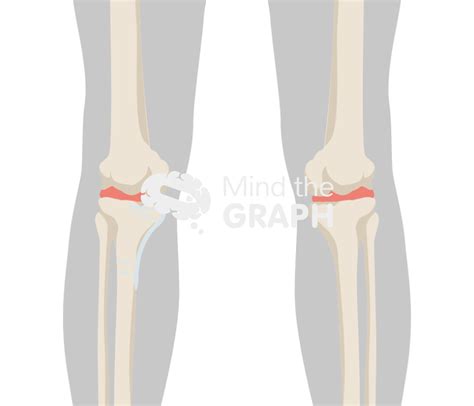 Free High Tibial Osteotomy Body Icons Symbols Pictures And Images