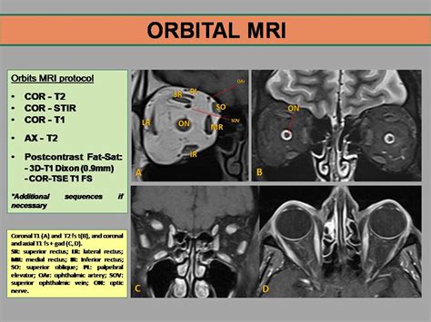 Orbit Mri Anatomy