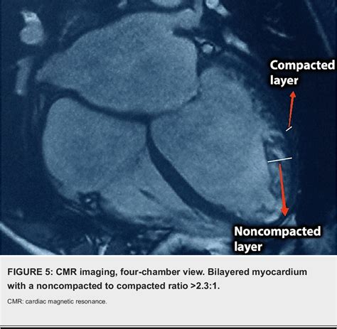 Pdf Left Ventricular Noncompaction Cardiomyopathy In An Elderly