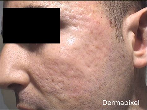 Dermapixel ¿cómo Me Puedo Quitar Las Marcas De Acné