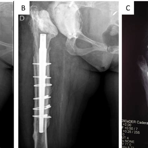 A Preoperative Radiograph Before The First Stage In A Patient With