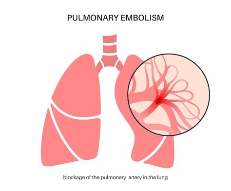 Premium Vector Pulmonary Embolism Disease