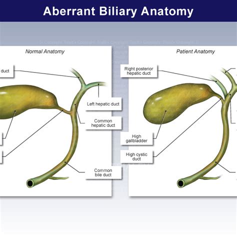 Infundibulum Gallbladder