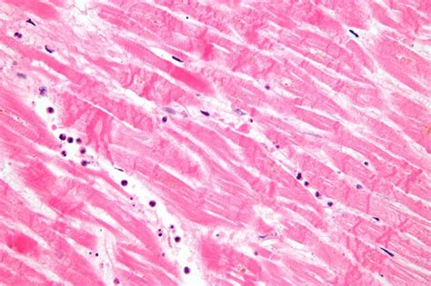 Pin On Forensic Pathology Natural Disease