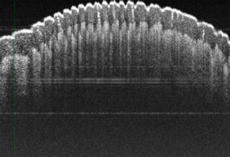 Ophthalmic Endoscopic Oct Rvm Medical