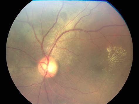 Hypertensive Choroidopathy Advanced Retina Care