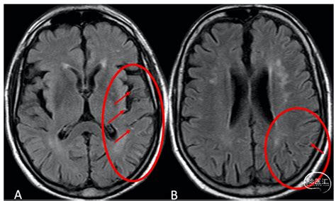 磁敏感加权成像上的多支低信号静脉是慢性狭窄 闭塞性疾病血流动力学受损的生物学标志物：一项多参数mri研究 脑医汇