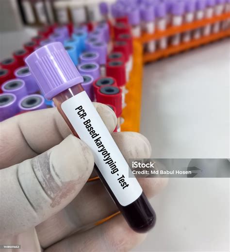 Pcr 기반 핵형 검사를 위한 혈액 샘플 유전 장애 염색체 분석 Dna에 대한 스톡 사진 및 기타 이미지 Dna Stem