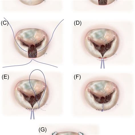 Mitral Valve Repair By A Triangular Resection Technique A Triangular