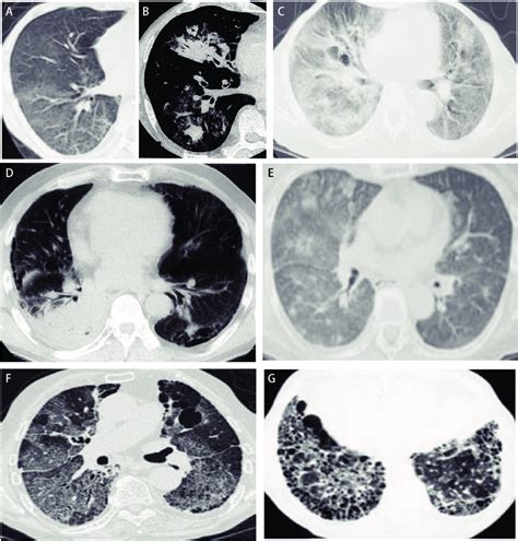 Ct Features Of Egfr Tki Induced Interstitial Lung Disease Download Scientific Diagram