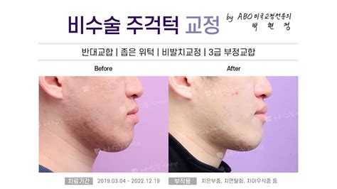 해운대센텀교정치과 뉴욕스마일치과 비수술주걱턱교정반대교합좁은위턱비발치교정3급부정교합 Banda 해운대좌동 장산역