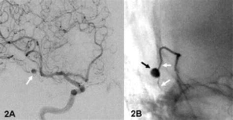 Onyx Coil Embolization Mri Safety At Lilian Knopwood Blog